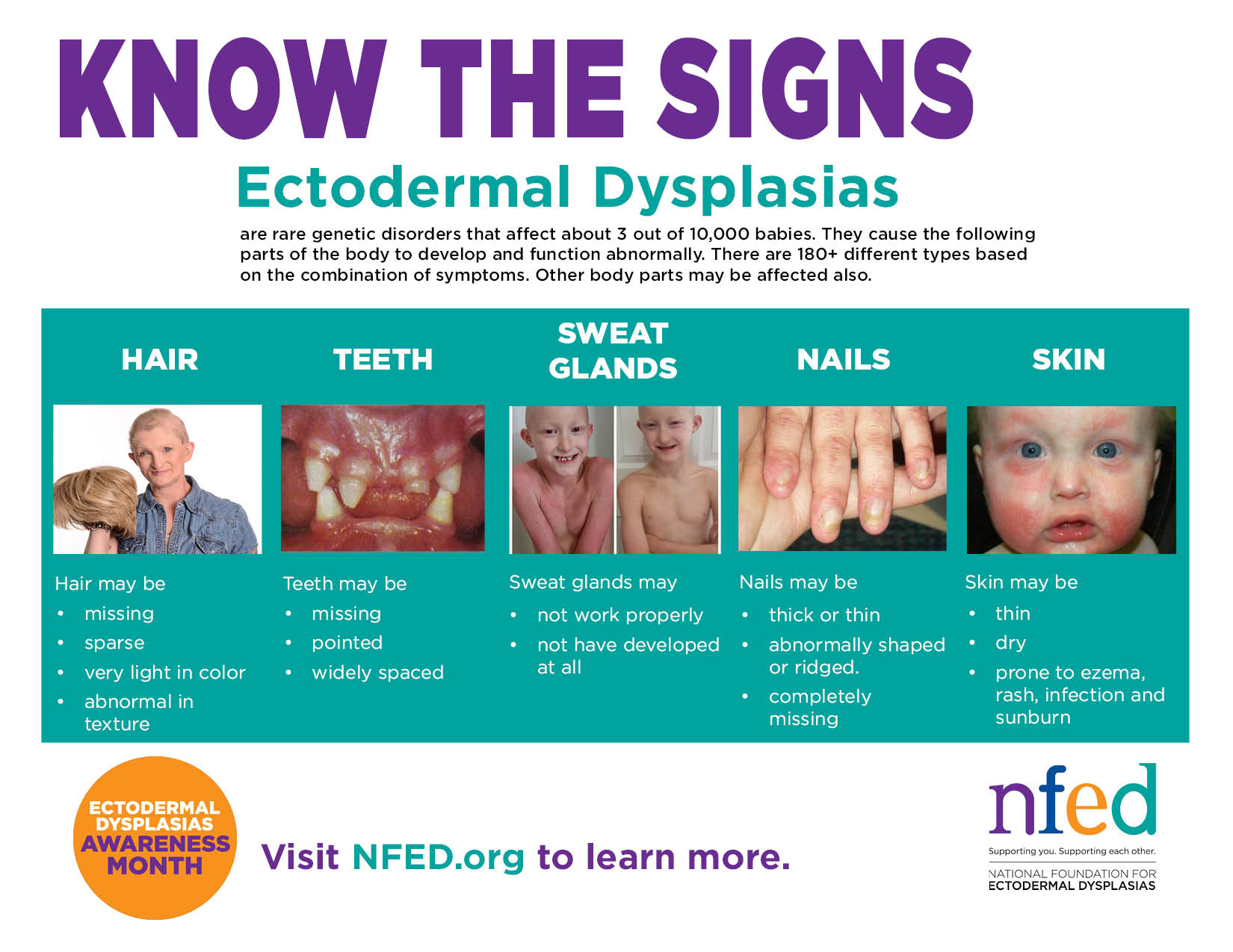 Ectodermal Dysplasias Awareness Month 2019 - NFED